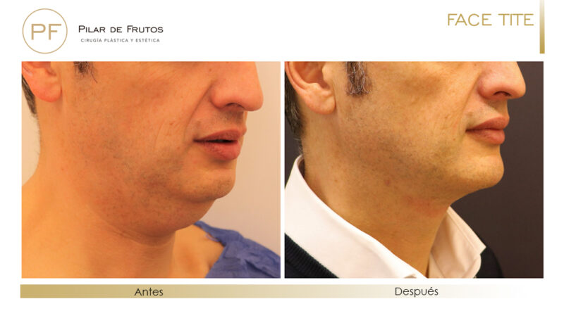 Quitar Papada: Fotos de antes y después con Face Tite y Blue Lift
