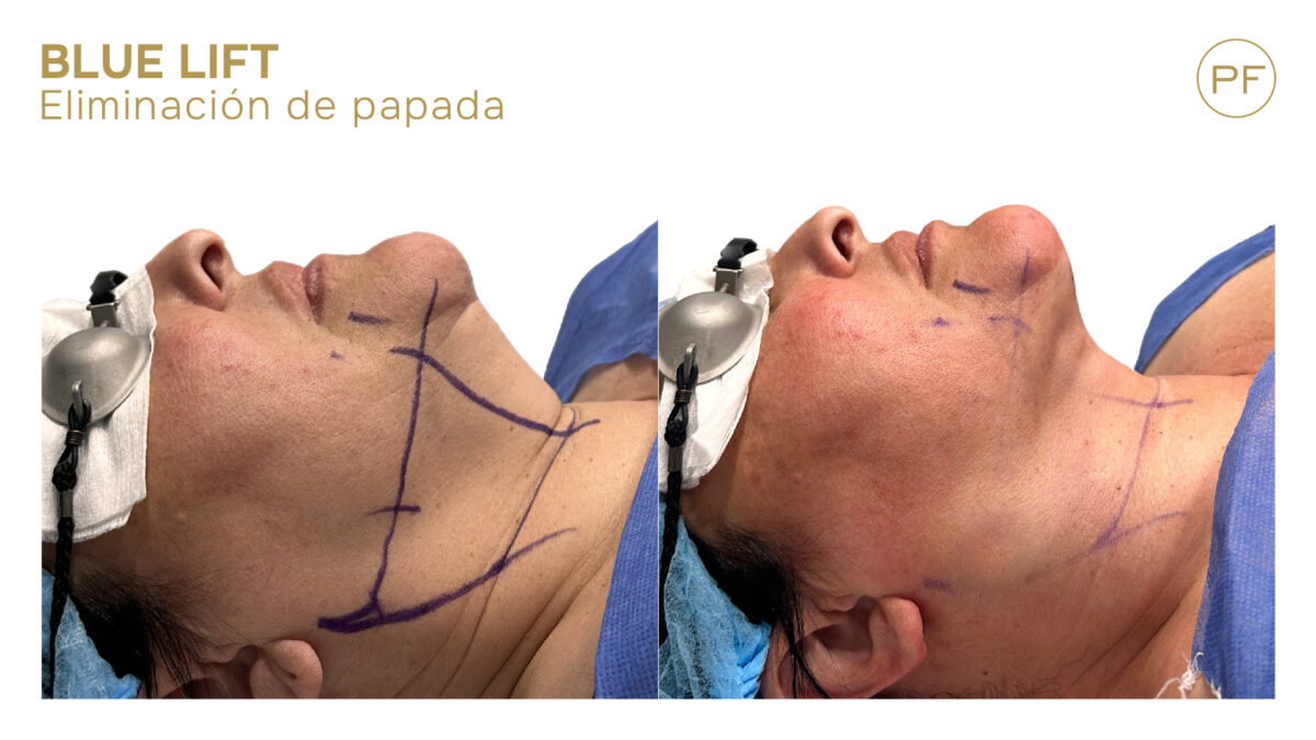 Quitar Papada: Fotos de antes y después con Face Tite y Blue Lift
