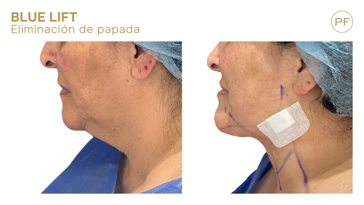 Quitar Papada: Fotos de antes y después con Face Tite y Blue Lift